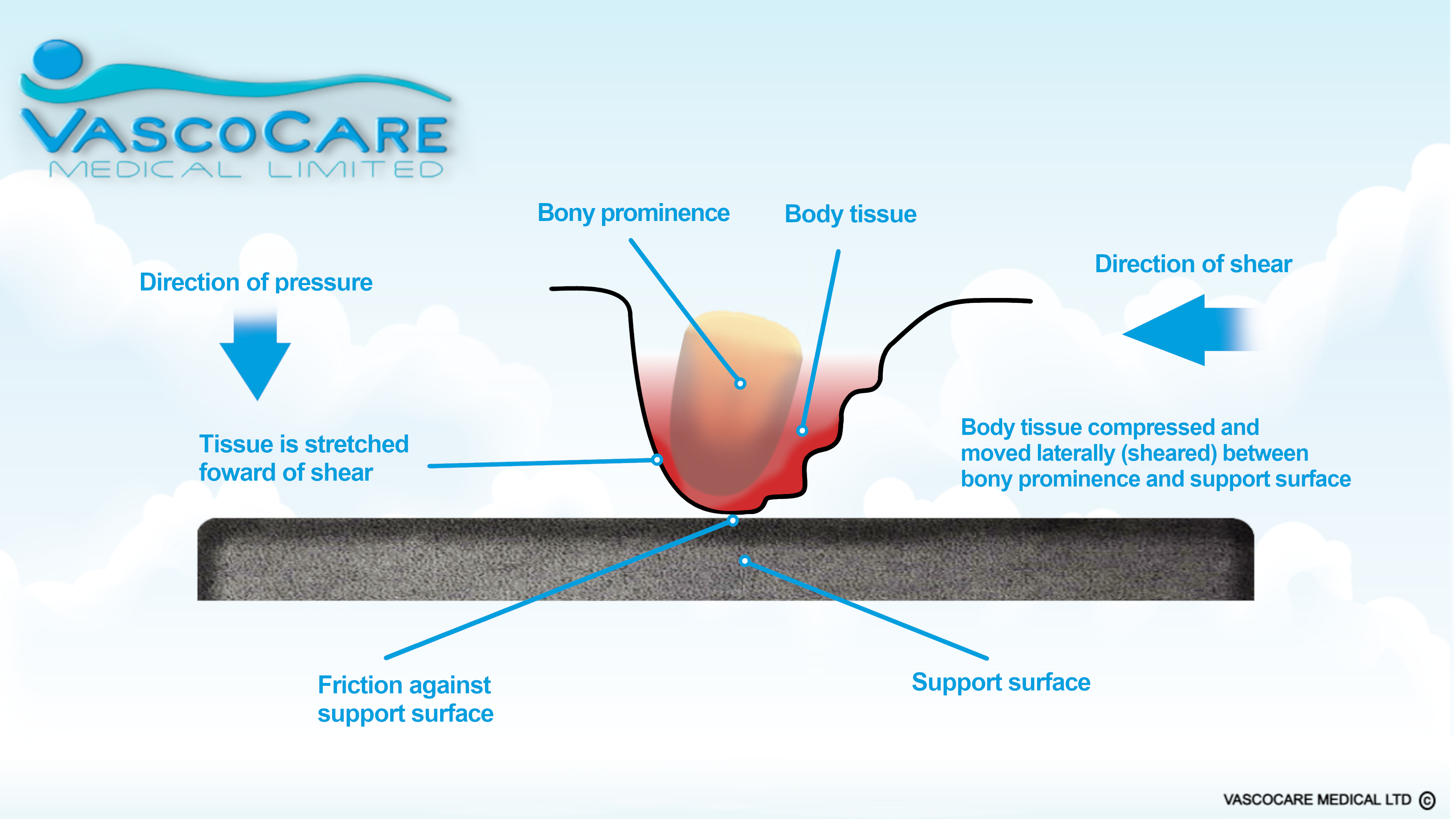 Eliminating Shear Forces in Patient Positioning: A Key to Pressure ...